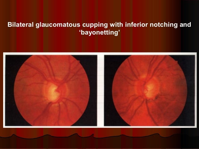 Anatomy of the angle structure (glaucoma)