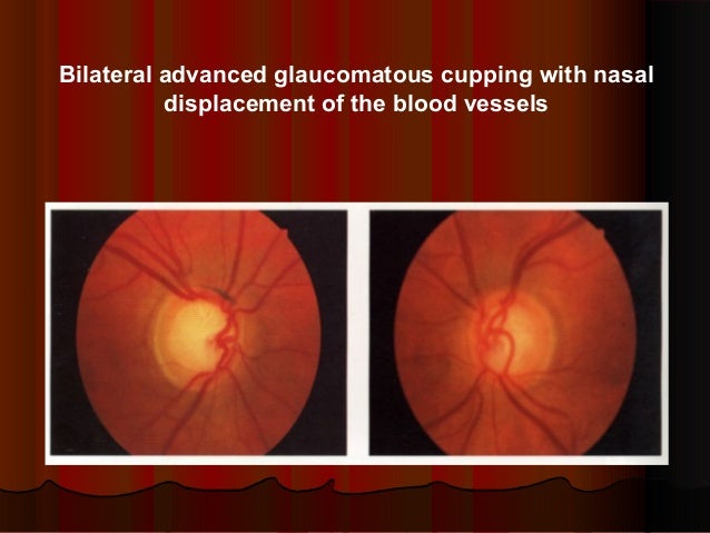 Anatomy of the angle structure (glaucoma)