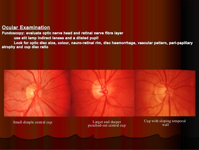 Anatomy of the angle structure (glaucoma)
