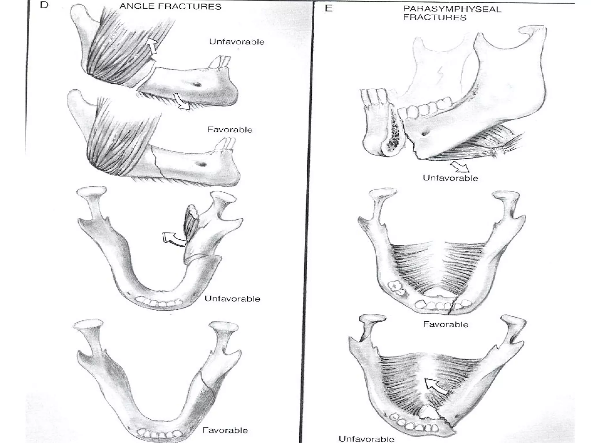 Anatomy and-fractures-of-the-mandible | PPT