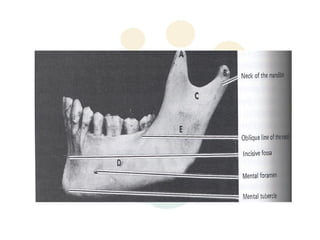 Anatomy and-fractures-of-the-mandible | PPT