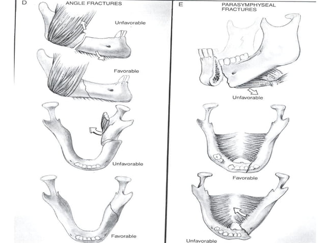 Anatomy and-fractures-of-the-mandible | PPT | Death, Injury, or ...