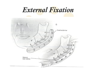 Anatomy and-fractures-of-the-mandible | PPT