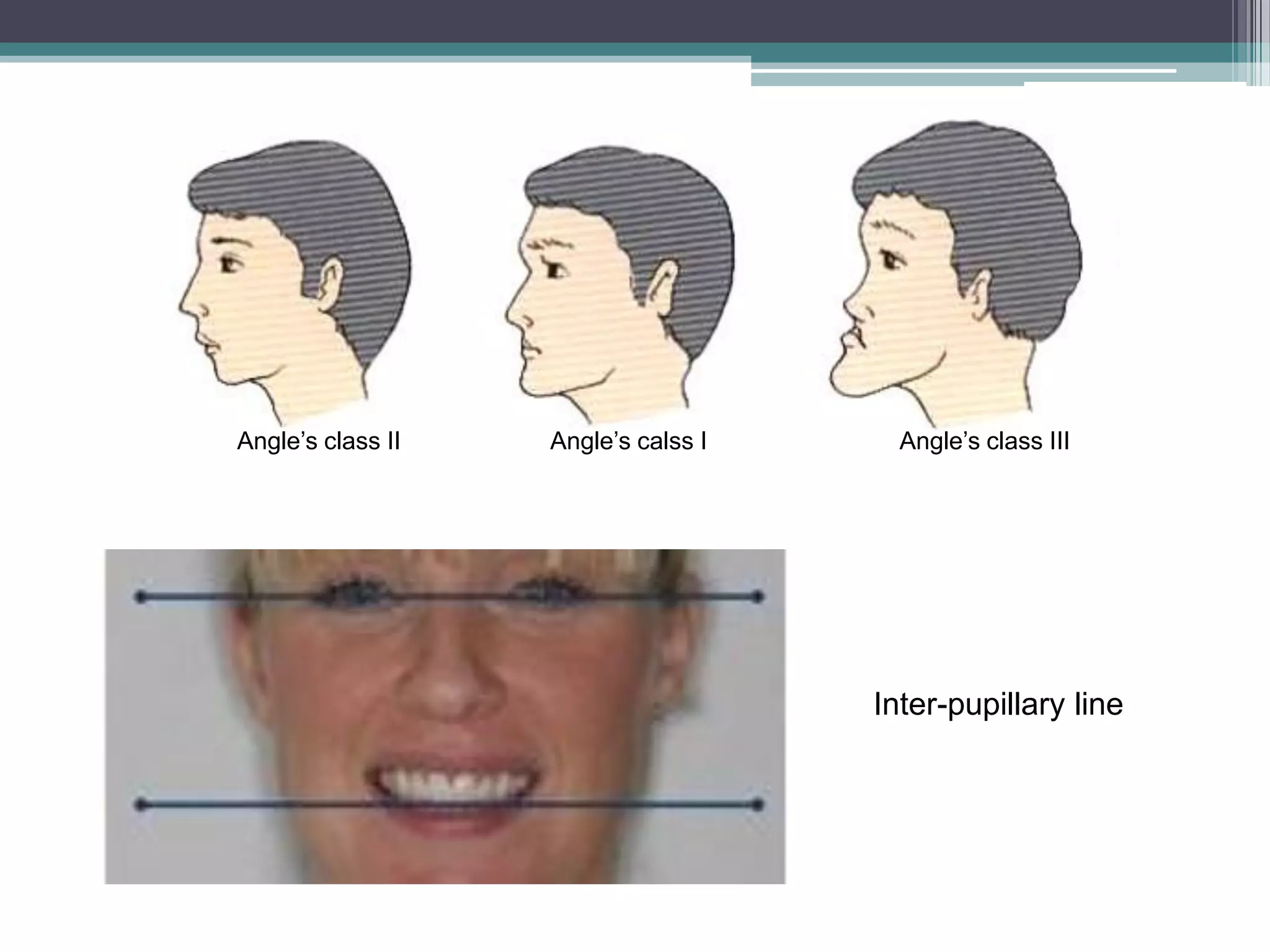 Anatomy complete denture | PDF