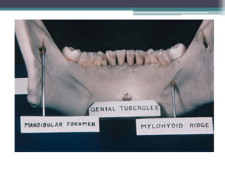 Anatomy complete denture | PDF