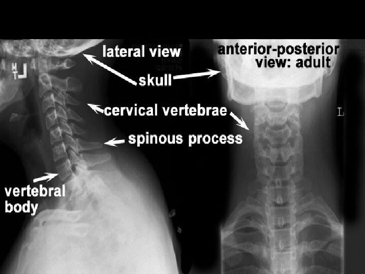 Cervical spine torn ligament x ray - sciencesaad
