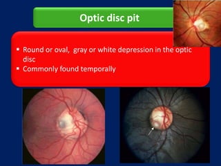 Anatomy of Optic Nerve | PPTX