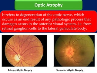 Anatomy of Optic Nerve | PPTX
