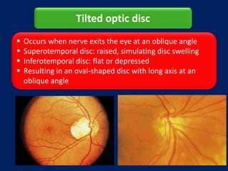 Anatomy of Optic Nerve | PPT