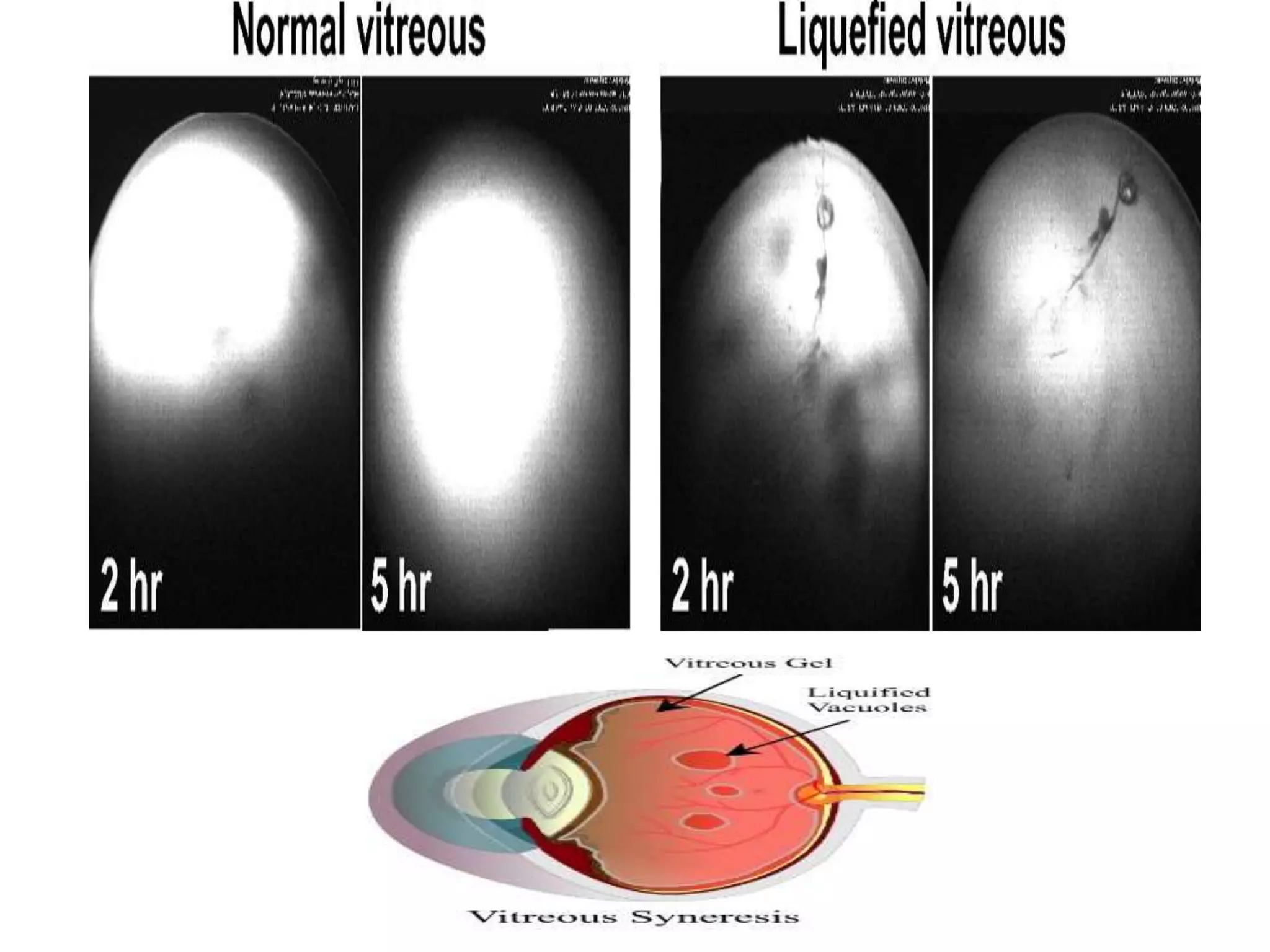 Anatomy of vitreous | PPTX