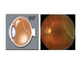 Anatomy of vitreous | PPTX