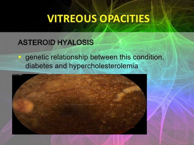 Anatomy of vitreous | PPTX | Eye and Vision Conditions | Diseases and ...