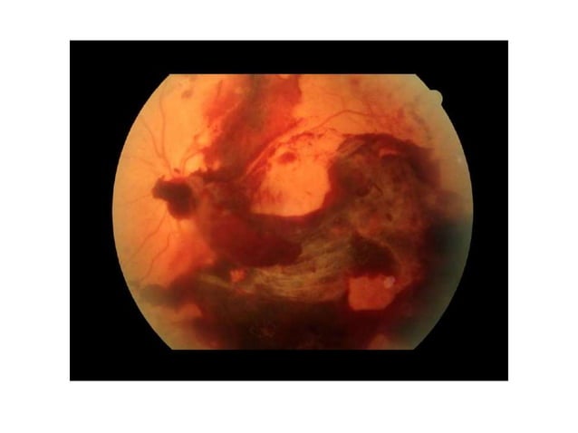 Anatomy of vitreous | PPTX | Eye and Vision Conditions | Diseases and ...