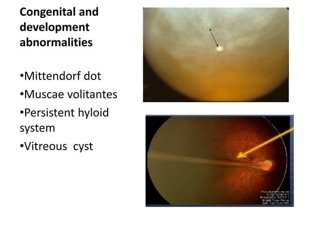 Anatomy of vitreous | PPTX | Eye and Vision Conditions | Diseases and ...