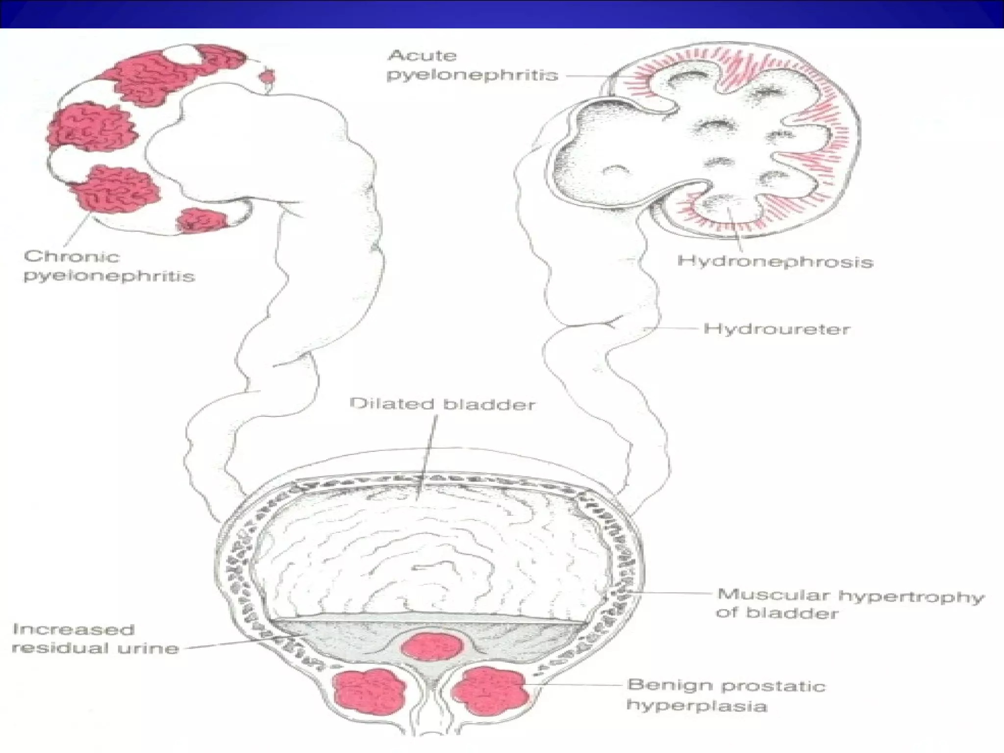 Anatomy urinary tract proplems&stons | PPT