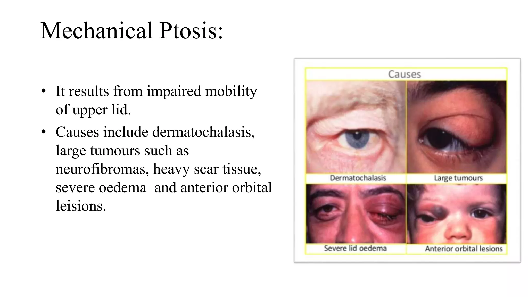 Anatomy Of Eyelid And Ptosis | PPTX