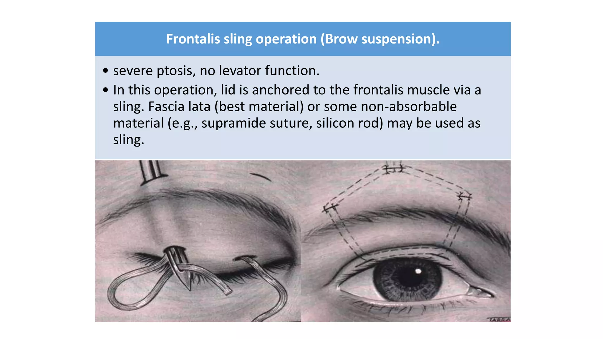 Anatomy Of Eyelid And Ptosis | PPTX