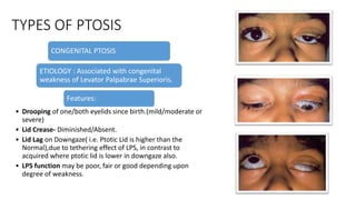 Anatomy Of Eyelid And Ptosis | PPTX