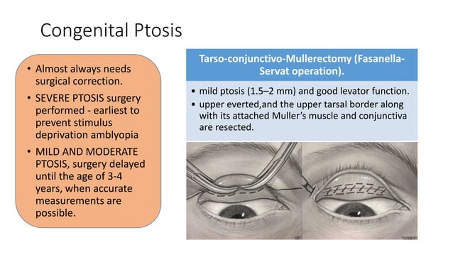 Anatomy Of Eyelid And Ptosis | PPTX | Eye and Vision Conditions ...