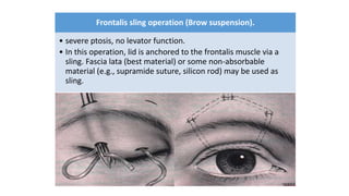 Anatomy Of Eyelid And Ptosis | PPT