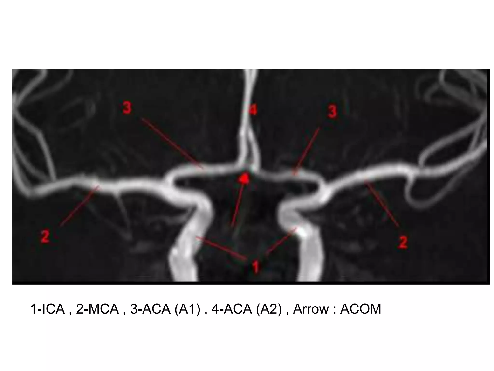 Anatomy of the anterior cerebral artery (ACA) | PPT