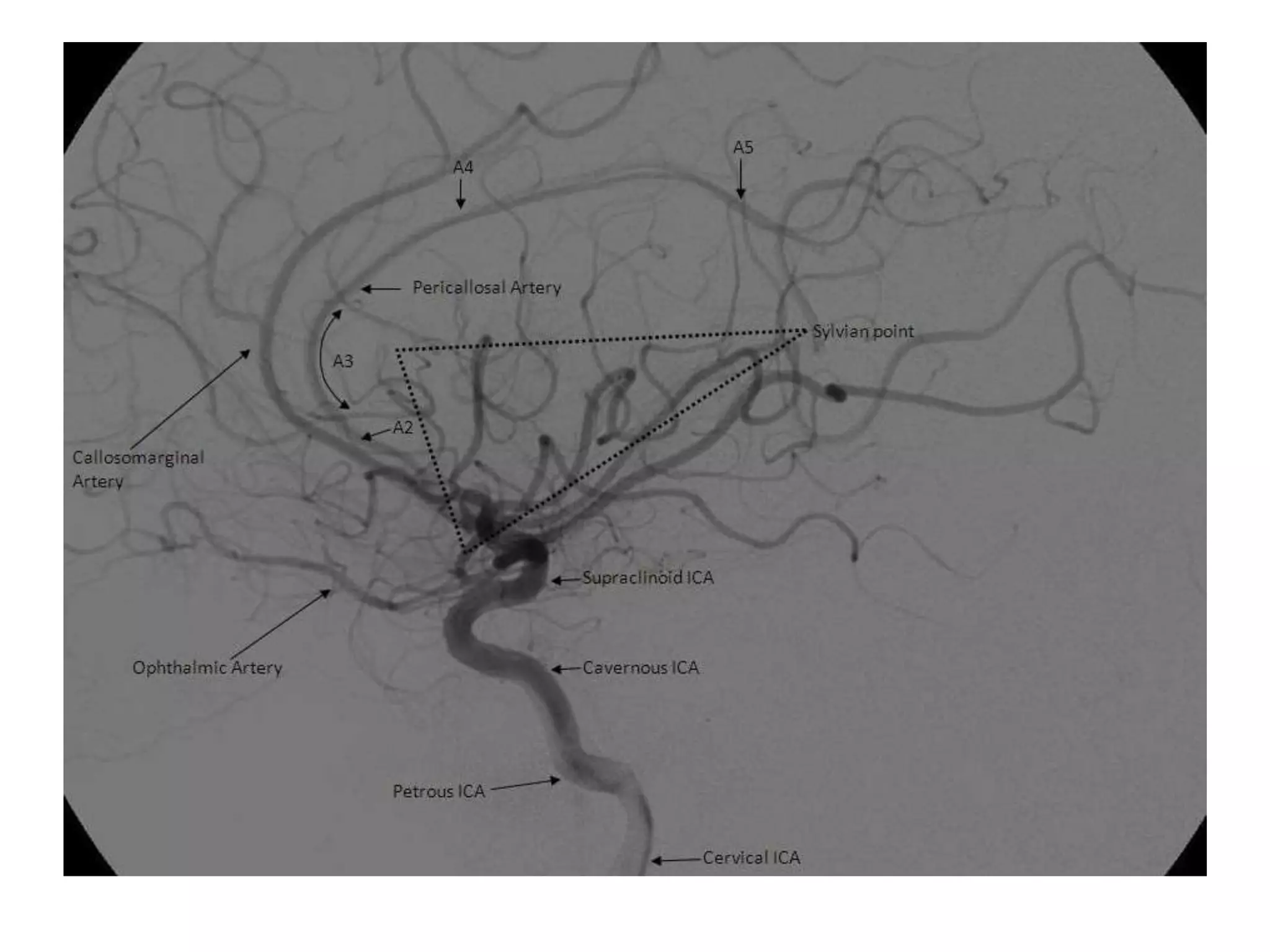 Anatomy of the anterior cerebral artery (ACA) | PPT | Death, Injury, or ...