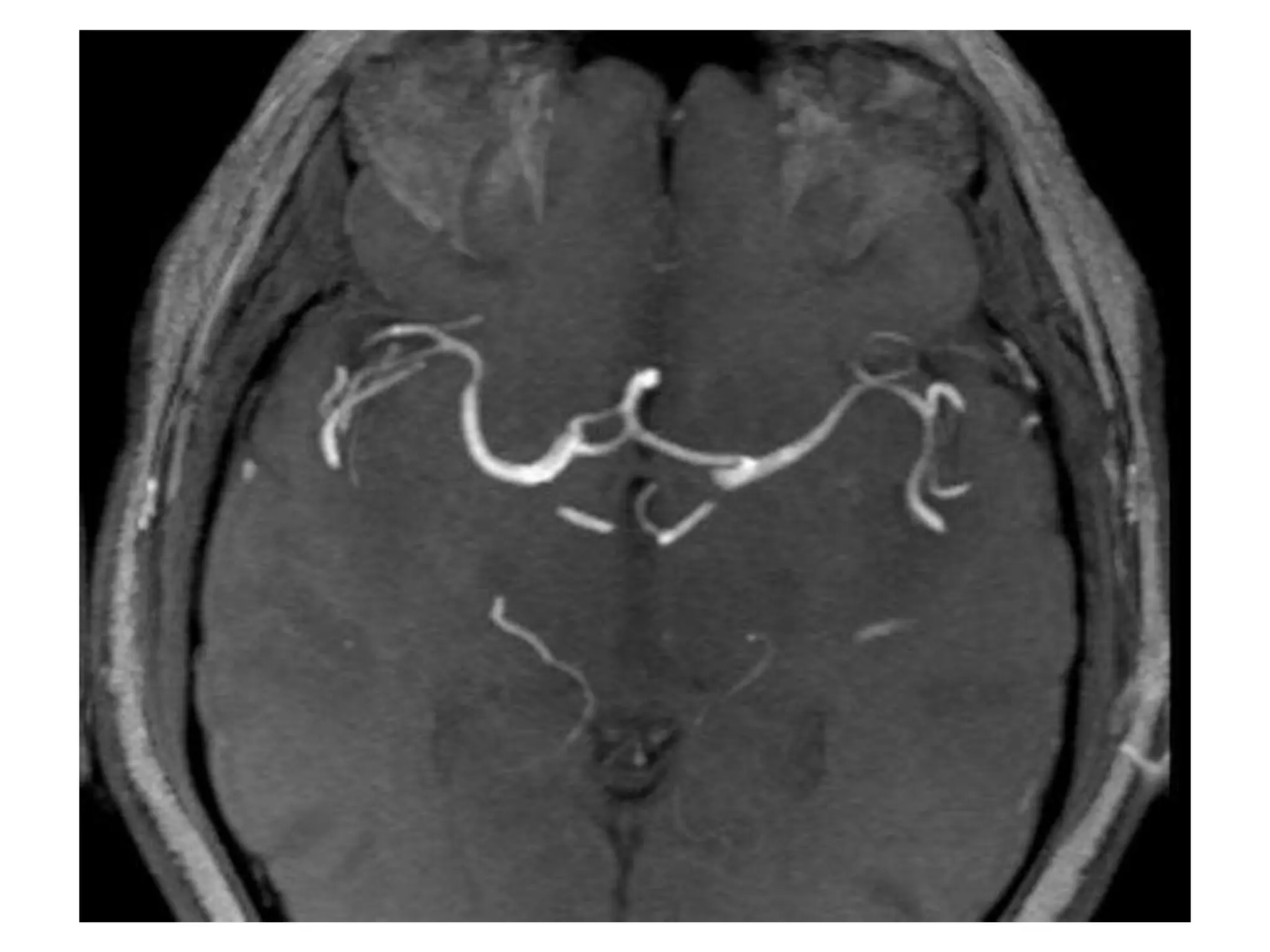 Anatomy of the anterior cerebral artery (ACA) | PPT