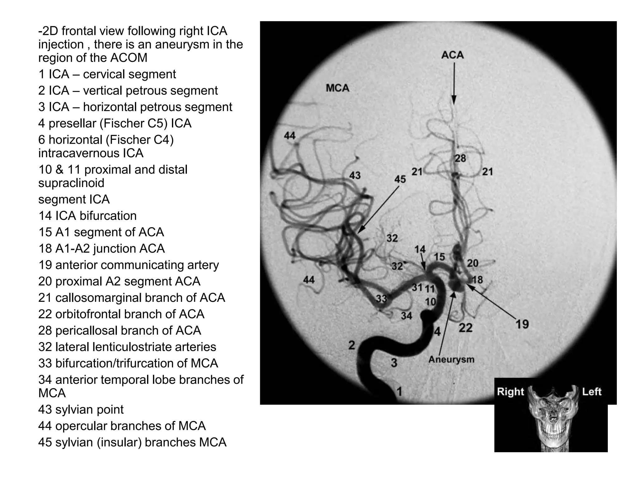 Anatomy of the anterior cerebral artery (ACA) | PPT