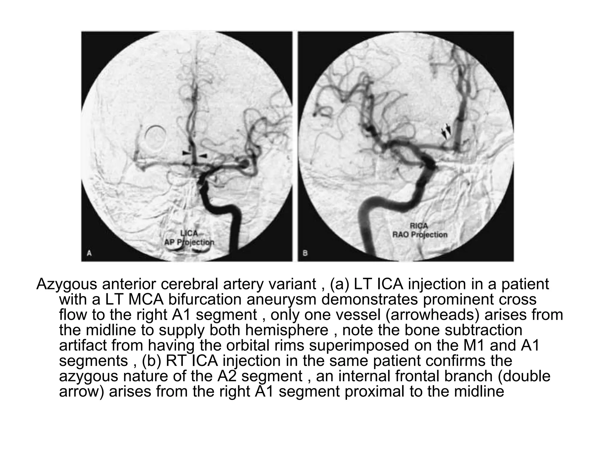 Anatomy of the anterior cerebral artery (ACA) | PPT