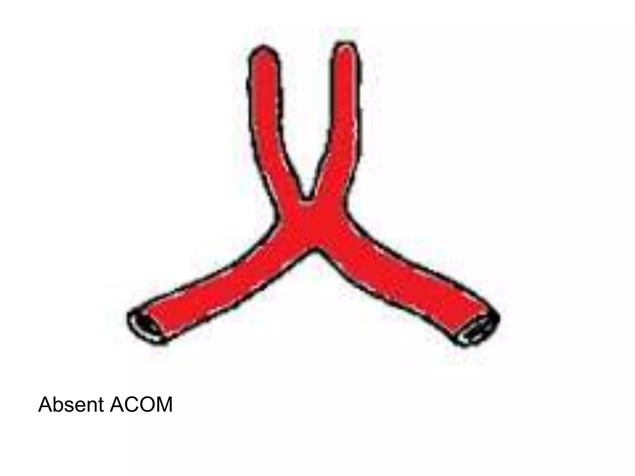 Anatomy of the anterior cerebral artery (ACA) | PPT