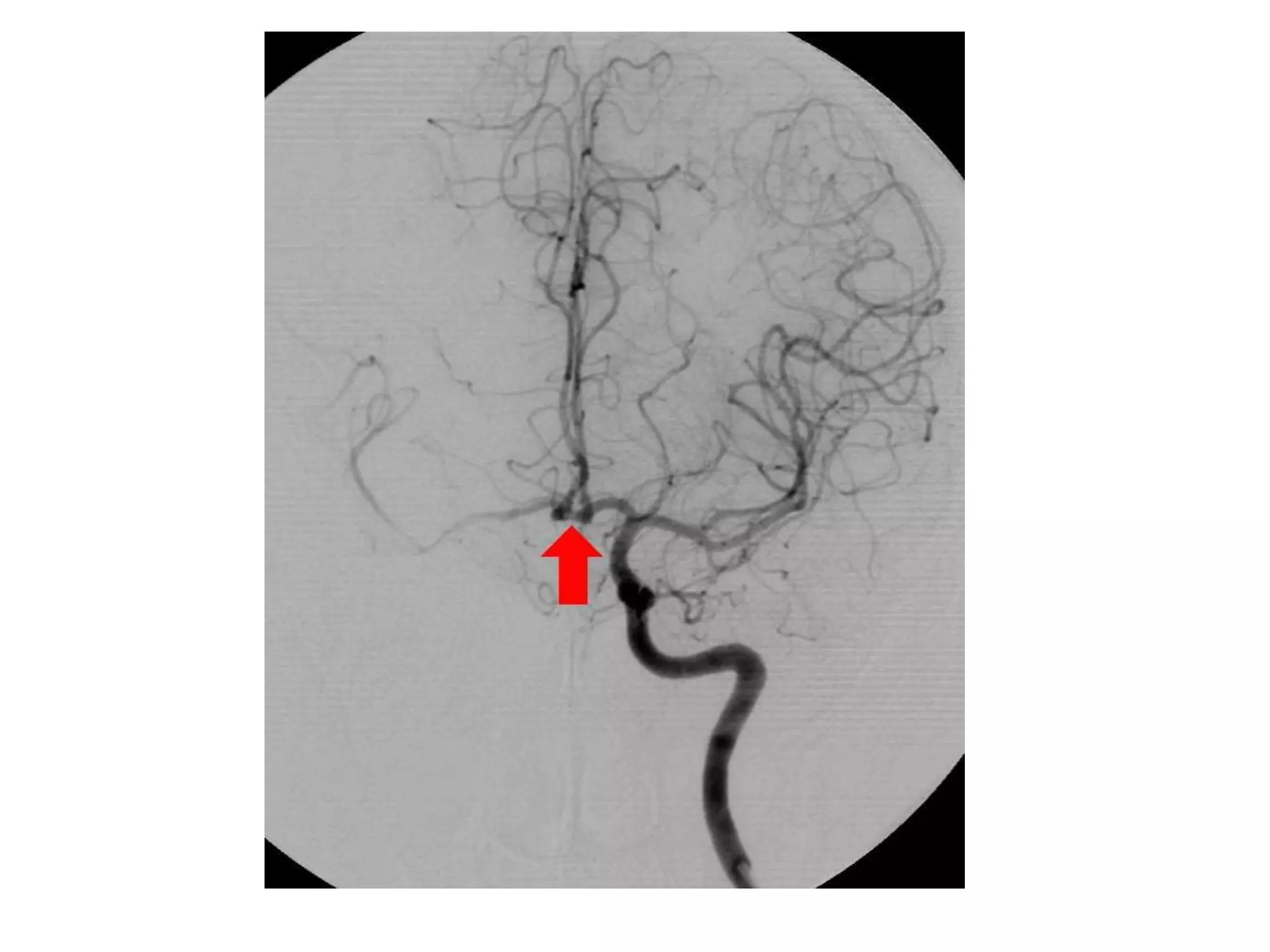Anatomy of the anterior cerebral artery (ACA) | PPT