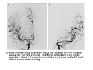 Anatomy of the anterior cerebral artery (ACA) | PPT