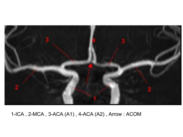 Anatomy of the anterior cerebral artery (ACA)