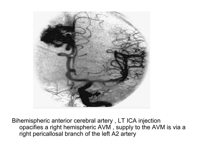 Anatomy of the anterior cerebral artery (ACA)