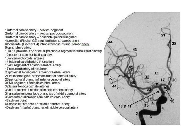 Anatomy of the anterior cerebral artery (ACA)