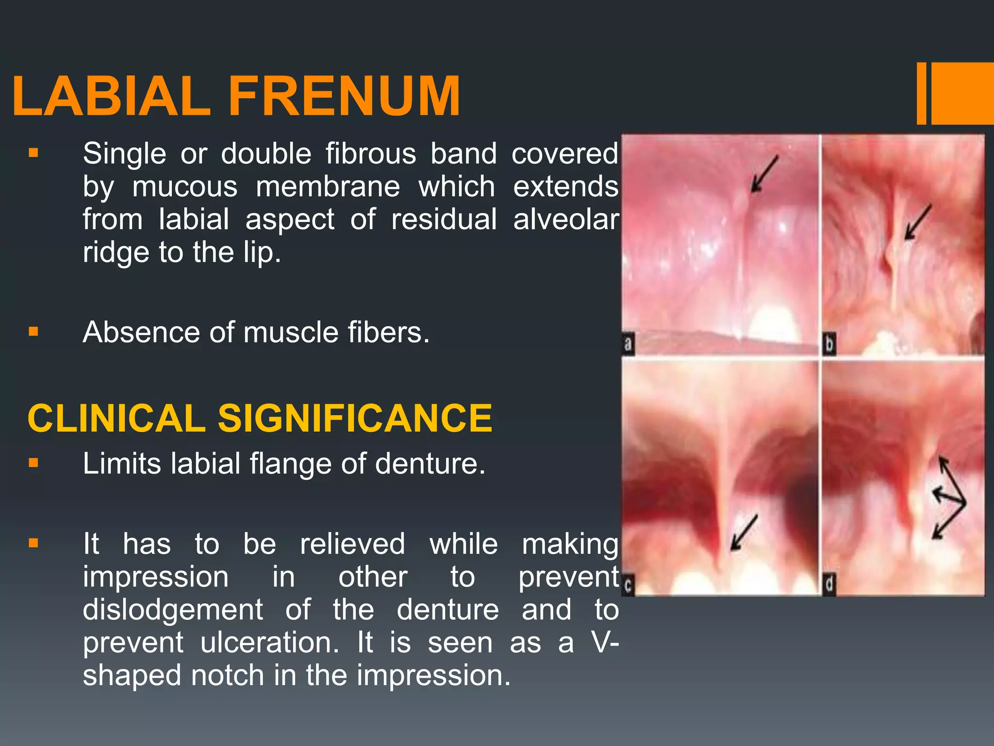 Anatomy and clinical significance of denture bearing areas | PPTX
