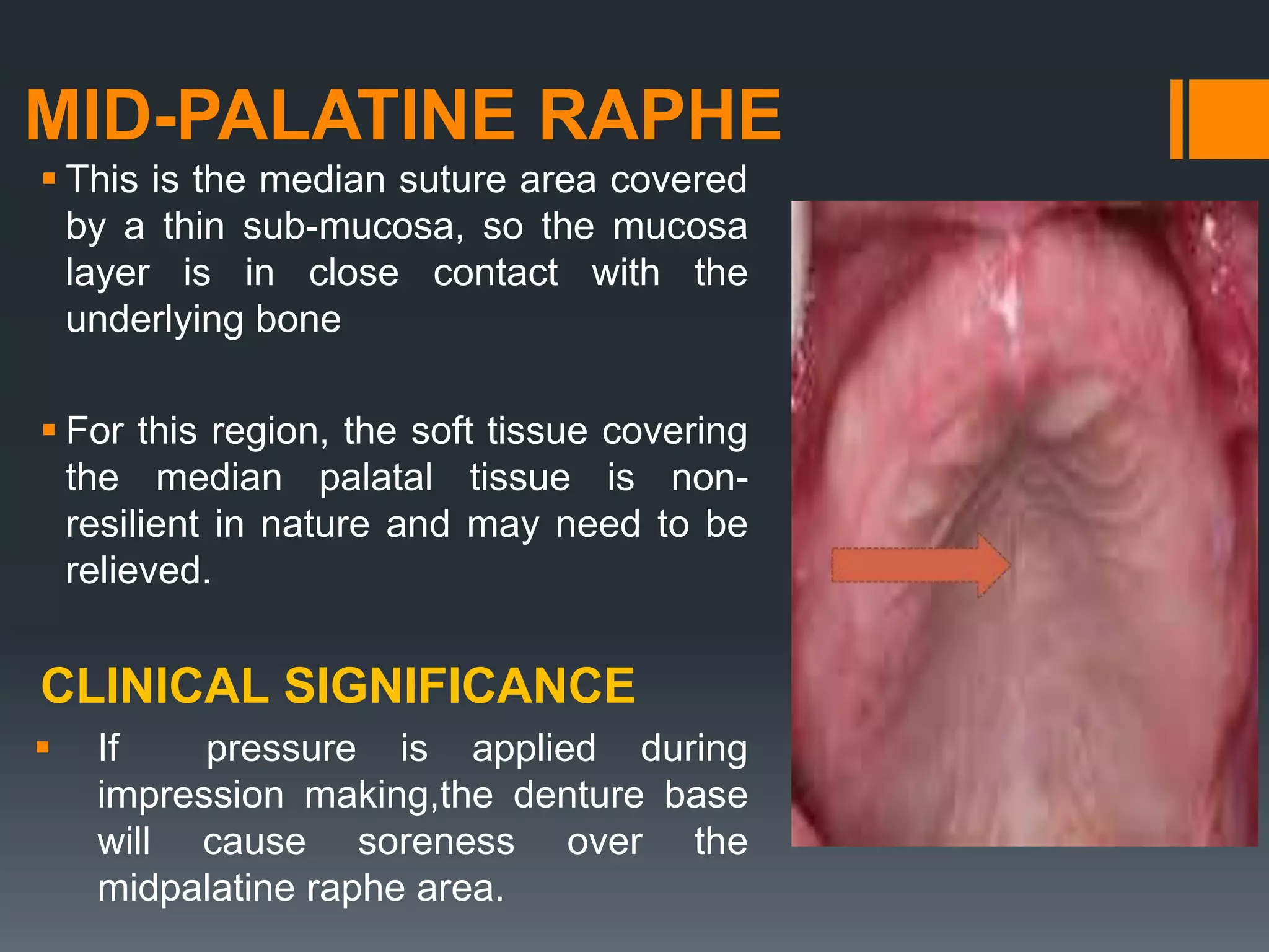 Anatomy and clinical significance of denture bearing areas | PPTX