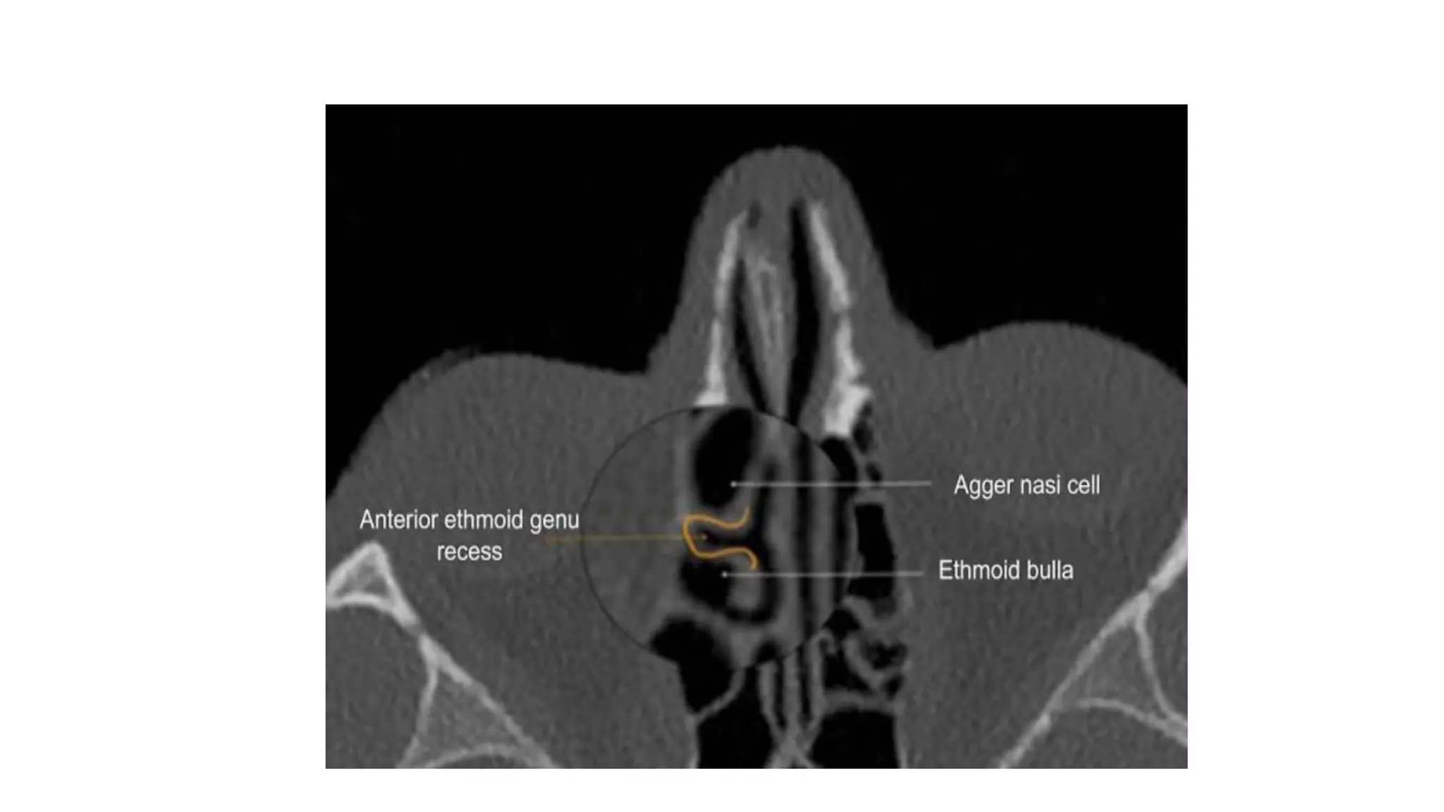 ANATOMY AND DEVELOPMENT OF PARANASAL SINUSES 2.pptx