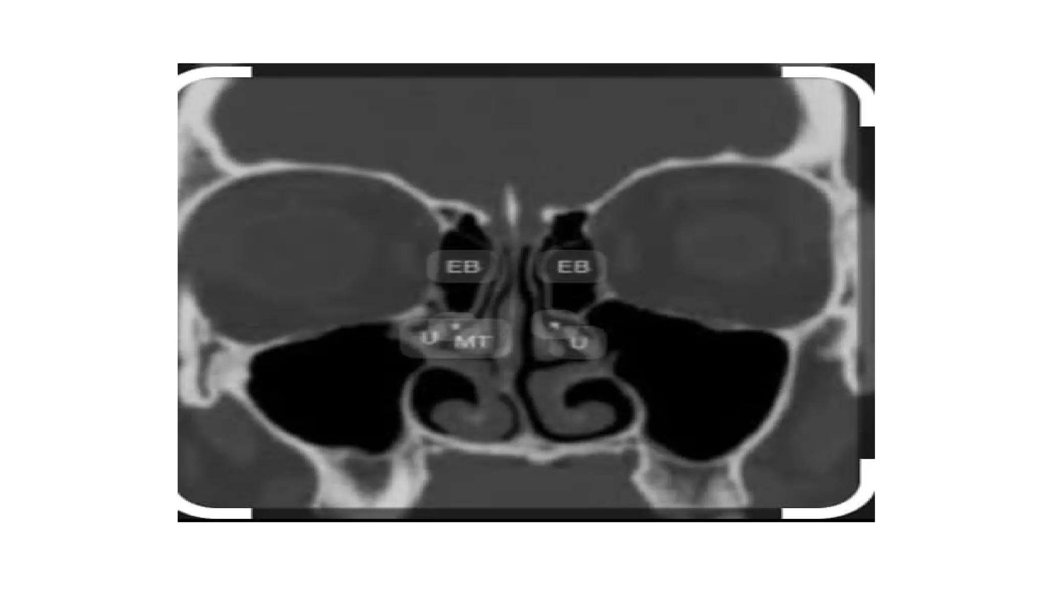 ANATOMY AND DEVELOPMENT OF PARANASAL SINUSES 2.pptx