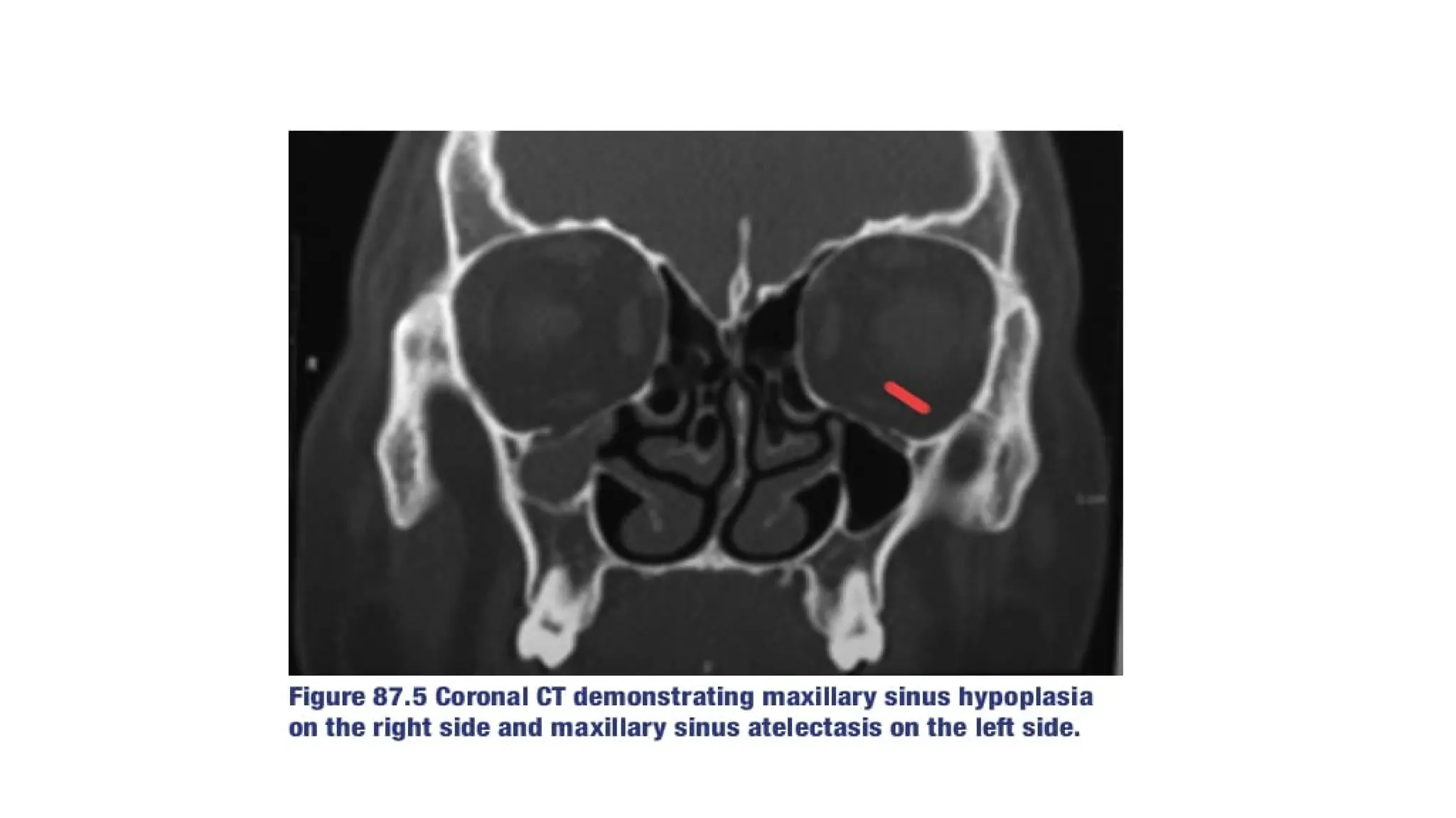 ANATOMY AND DEVELOPMENT OF PARANASAL SINUSES 2.pptx