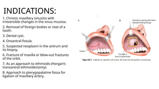 ANATOMY AND DEVELOPMENT OF PARANASAL SINUSES 2.pptx