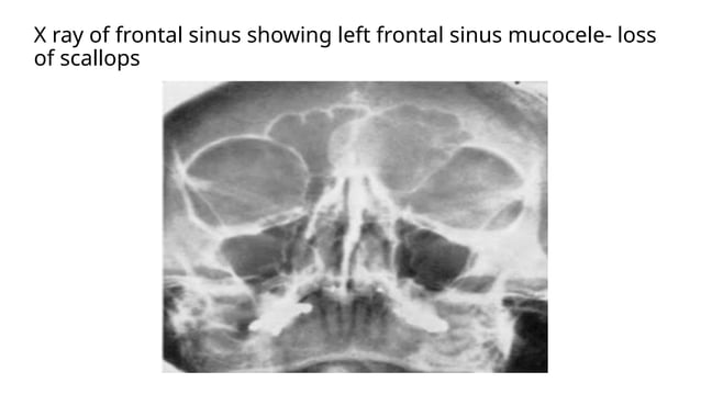ANATOMY AND DEVELOPMENT OF PARANASAL SINUSES 2.pptx