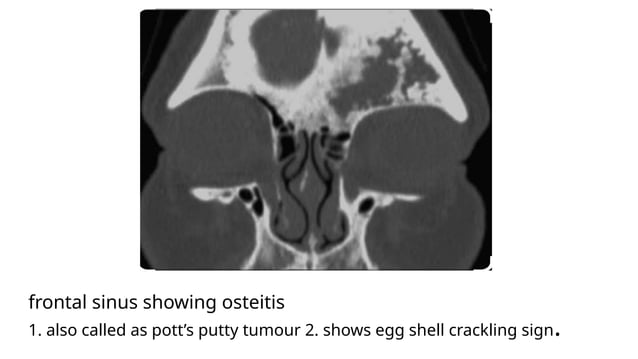 ANATOMY AND DEVELOPMENT OF PARANASAL SINUSES 2.pptx