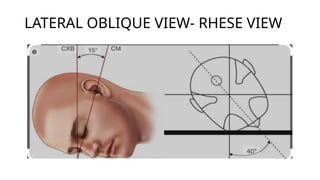 ANATOMY AND DEVELOPMENT OF PARANASAL SINUSES 2.pptx