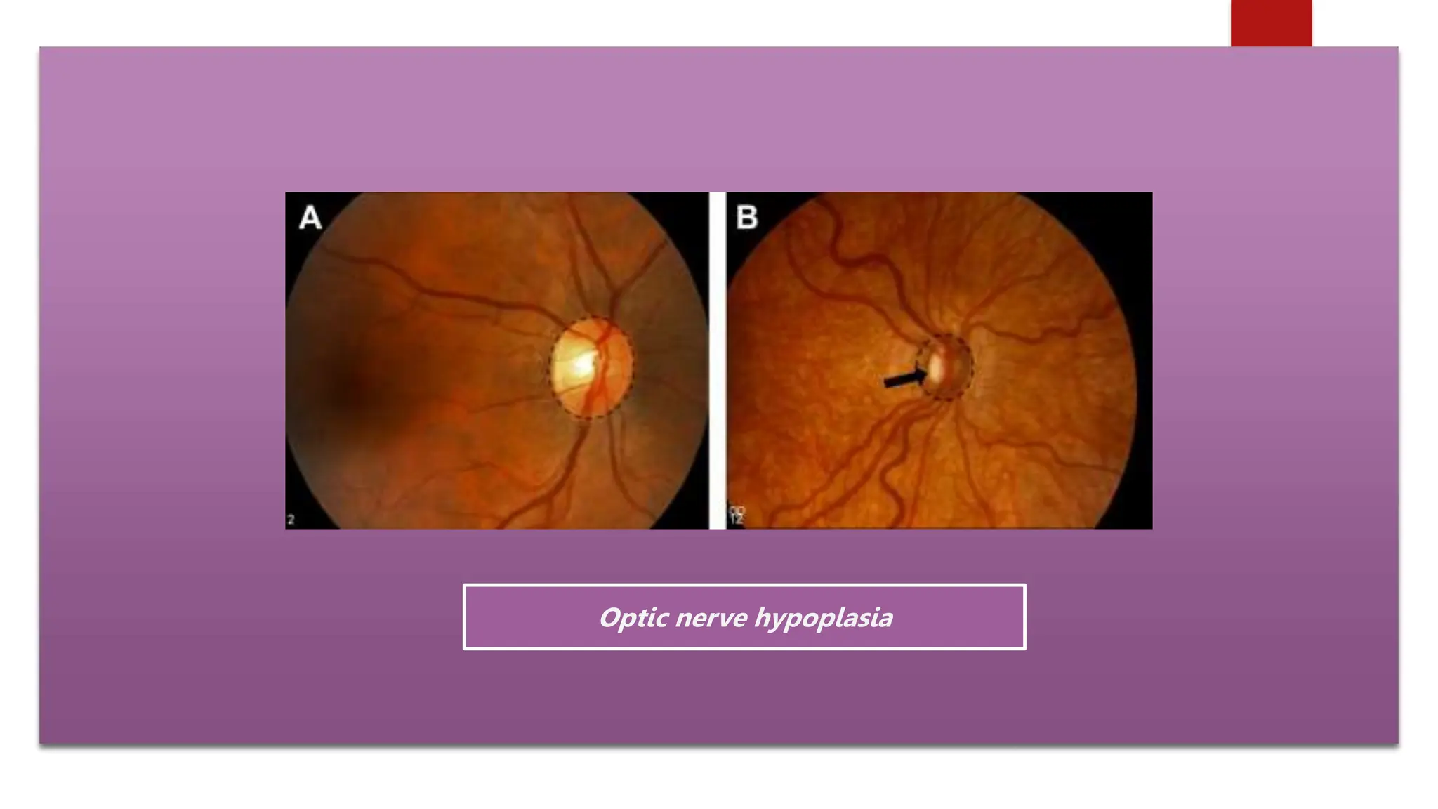 ANATOMY AND DEVELOPMENT OF THE HUMAN EYE. | PPTX