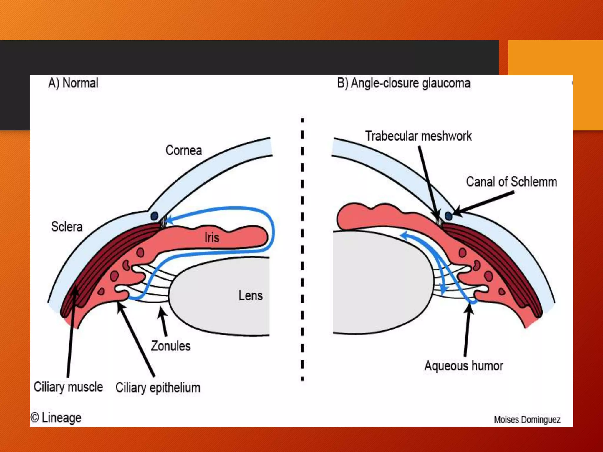 Anatomy and embryology of anterior chamber angle ppt new | PPTX
