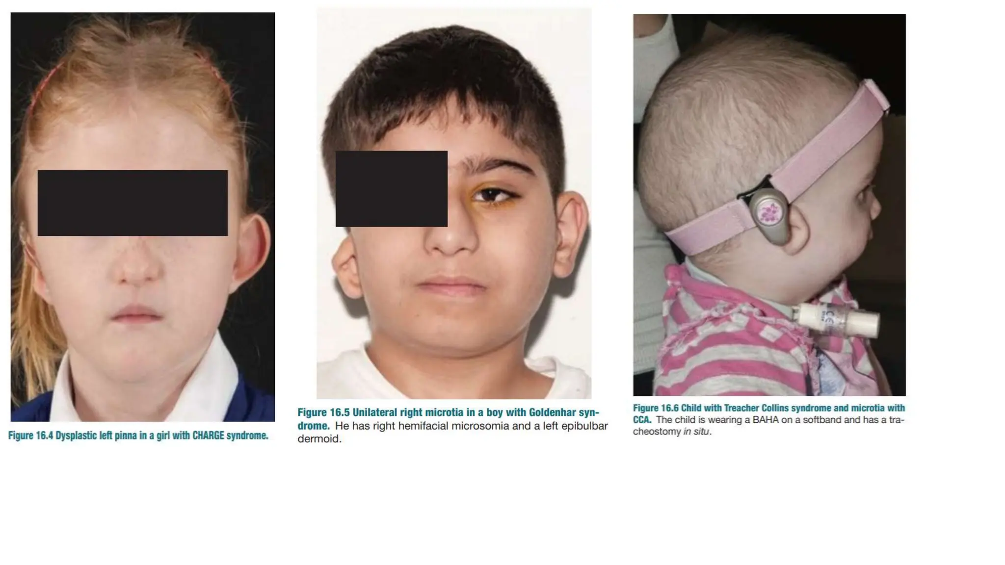 Anatomy and Embryology of External Ear.pptx