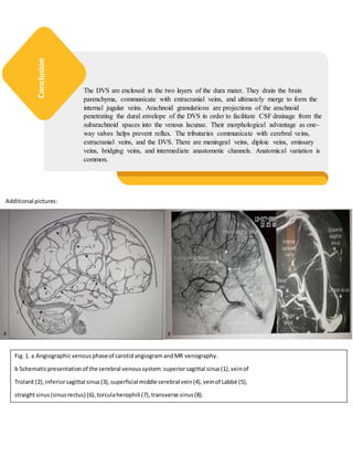 Anatomy and function of the dural venous sinuses | DOCX | Ear, Nose and ...