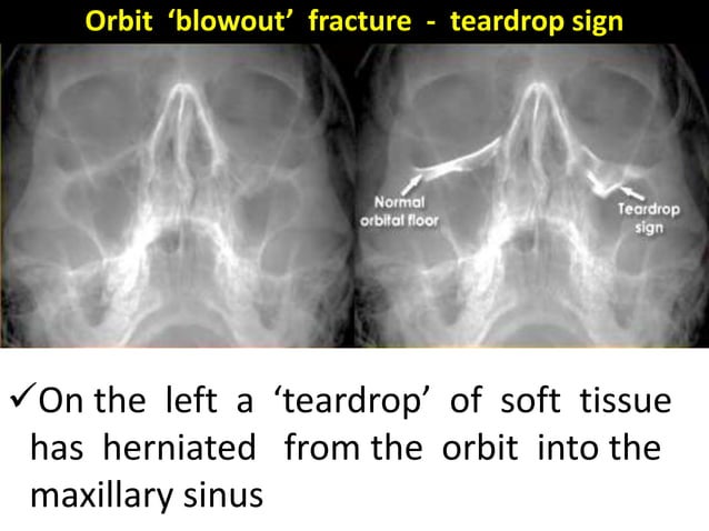 Anatomy and image interpretation of facial bone | PPTX | Death, Injury ...