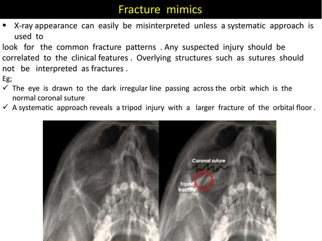 Anatomy and image interpretation of facial bone | PPTX | Death, Injury ...